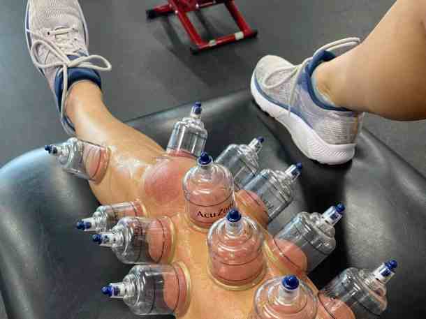 Cupping: Are Those Bruises Really Worth It? - Kaizo Health